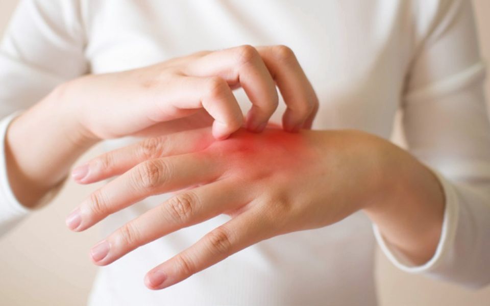 Santé – bien-être : eczéma des mains